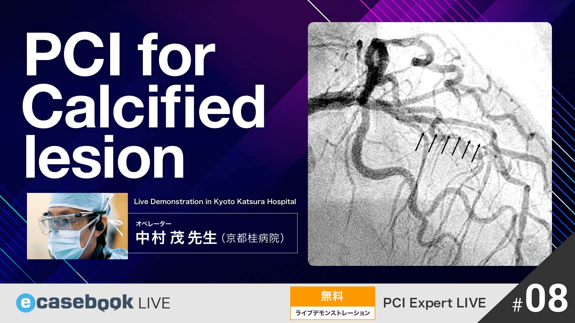 VIDEO: PCI for Calcified lesion | Cardiology | e-casebook LIVE