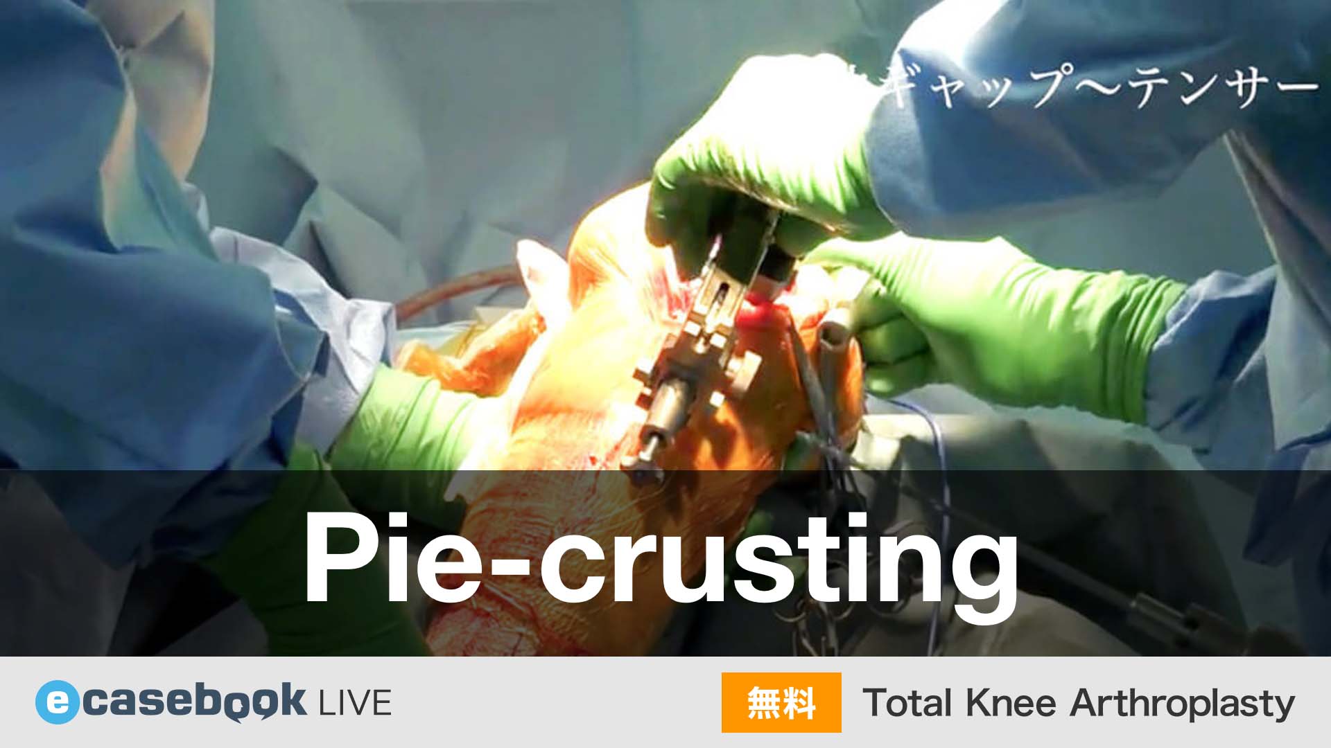 VIDEO: Pie-crusting [TKA] | Orthopedics | e-casebook LIVE