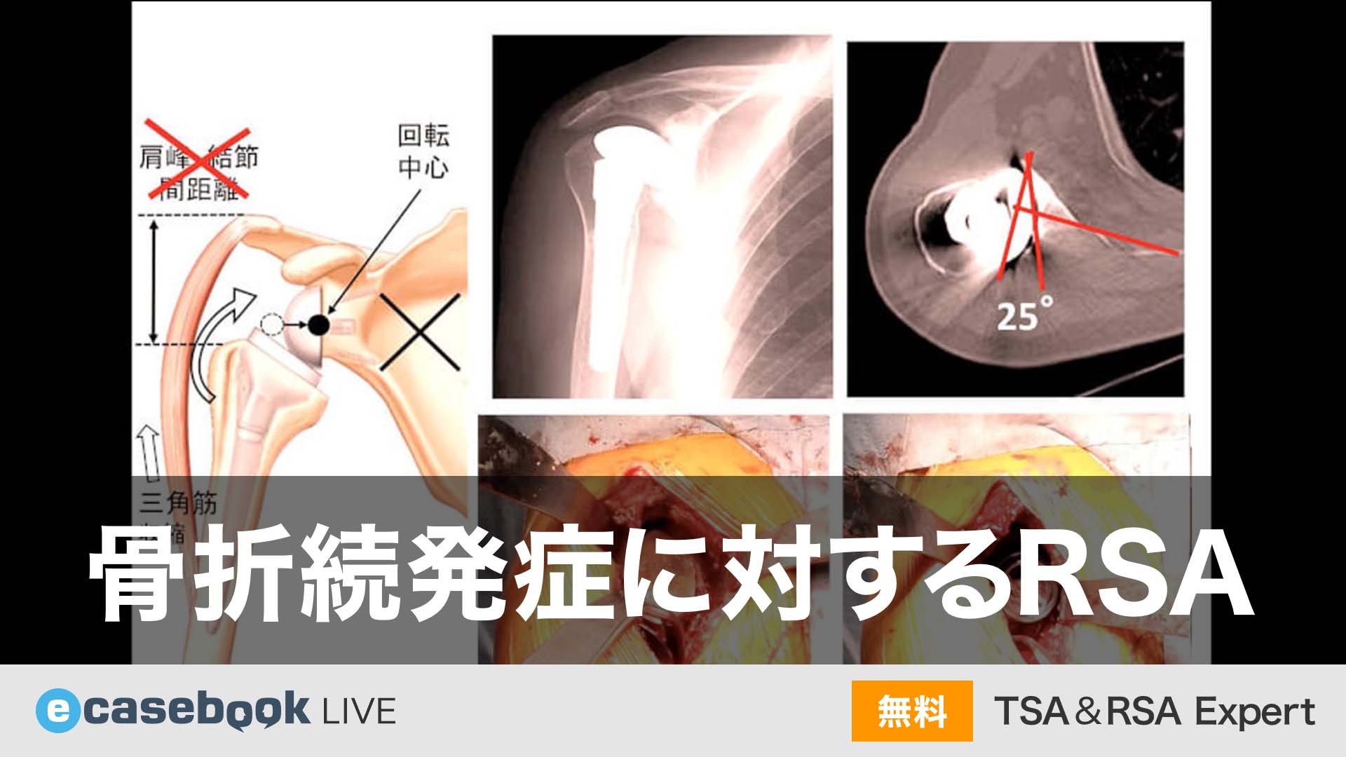 VIDEO: 骨折続発症に対するRSA [RSA] | Orthopedics | e-casebook LIVE
