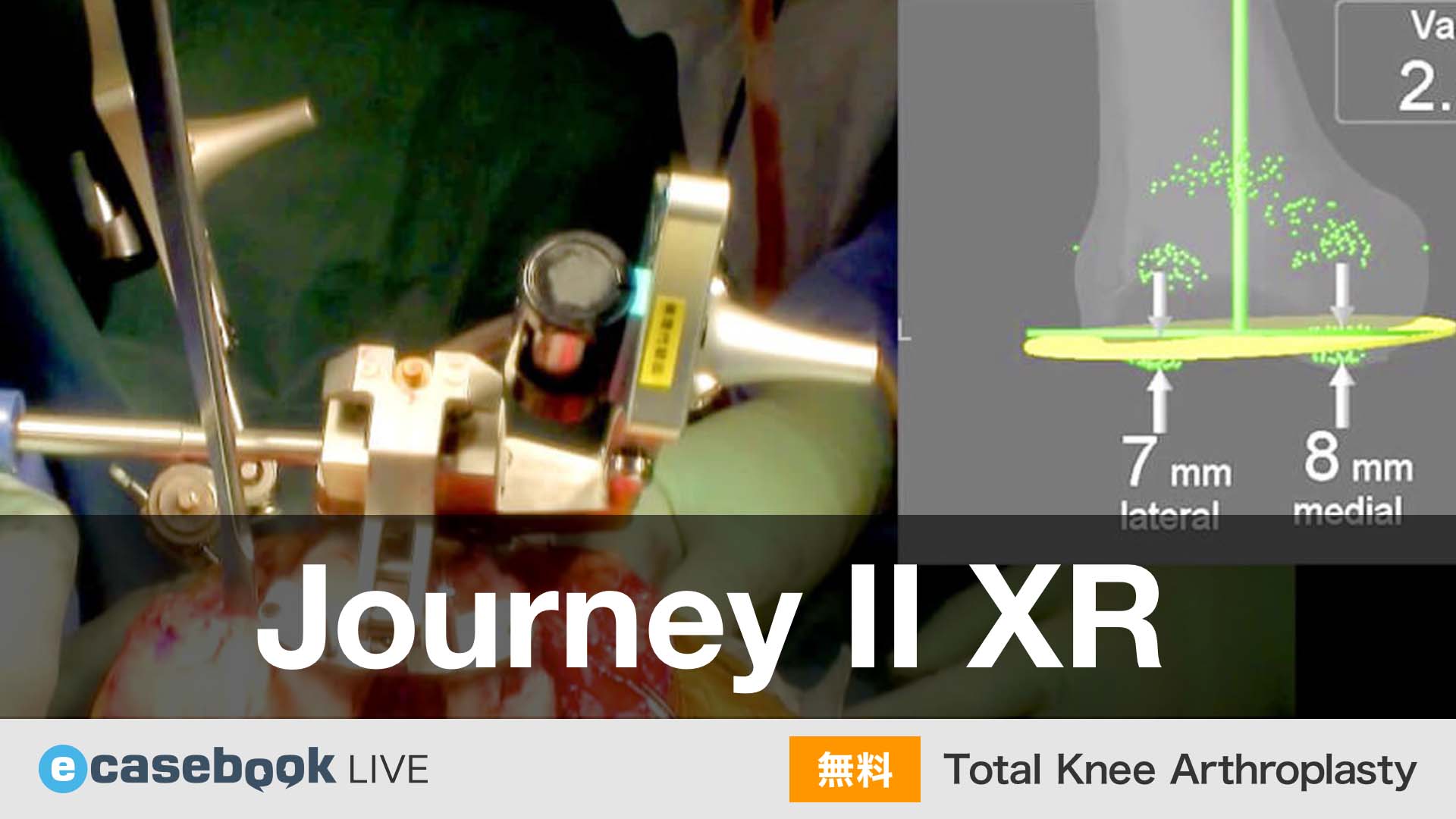 VIDEO: Journey II XR [TKA] | Orthopedics | e-casebook LIVE