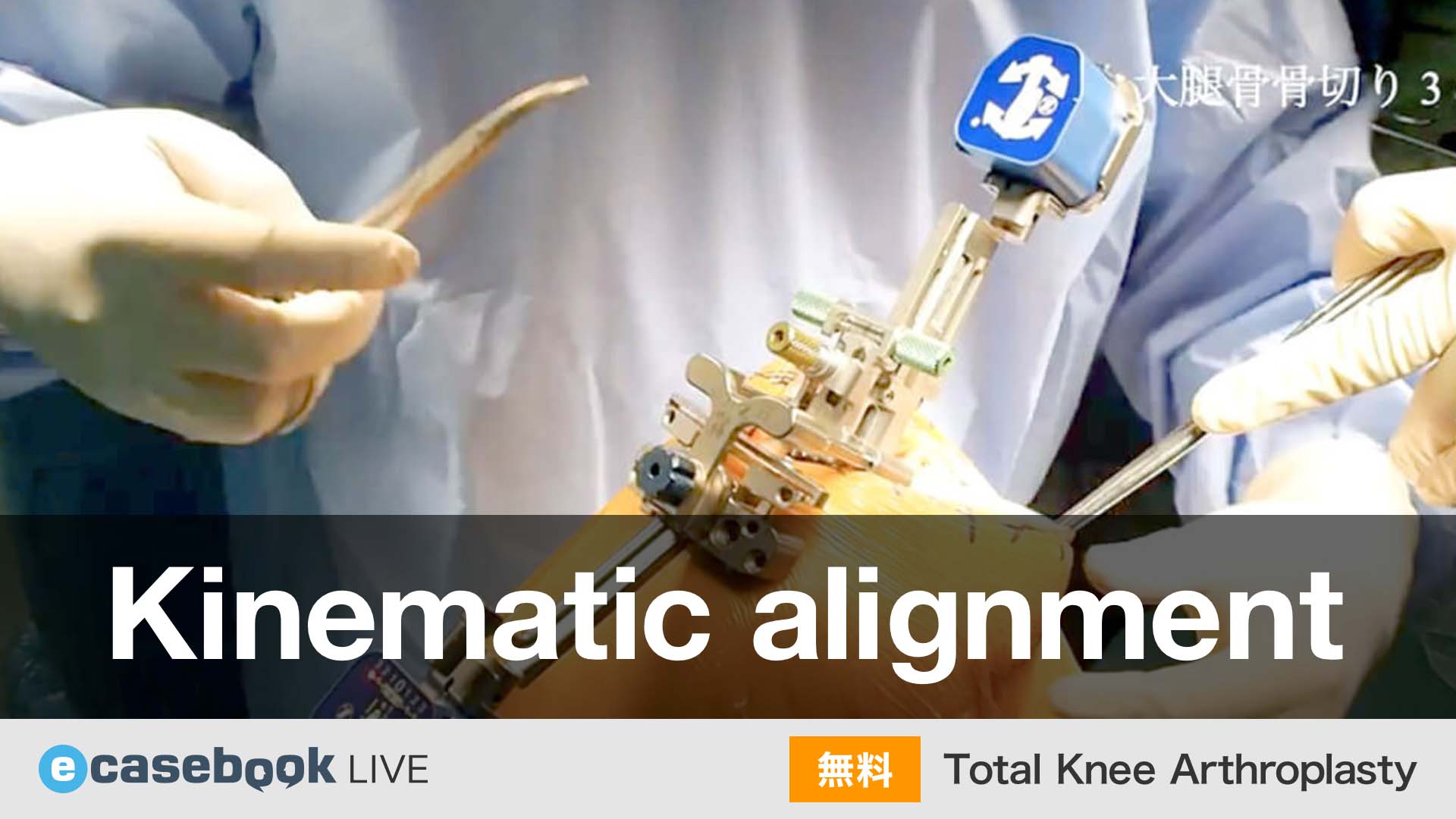 VIDEO: Kinematic alignment [TKA] | Orthopedics | e-casebook LIVE