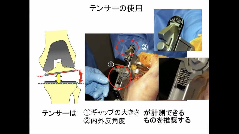 VIDEO: ギャップテクニック [TKA] | Orthopedics | e-casebook LIVE