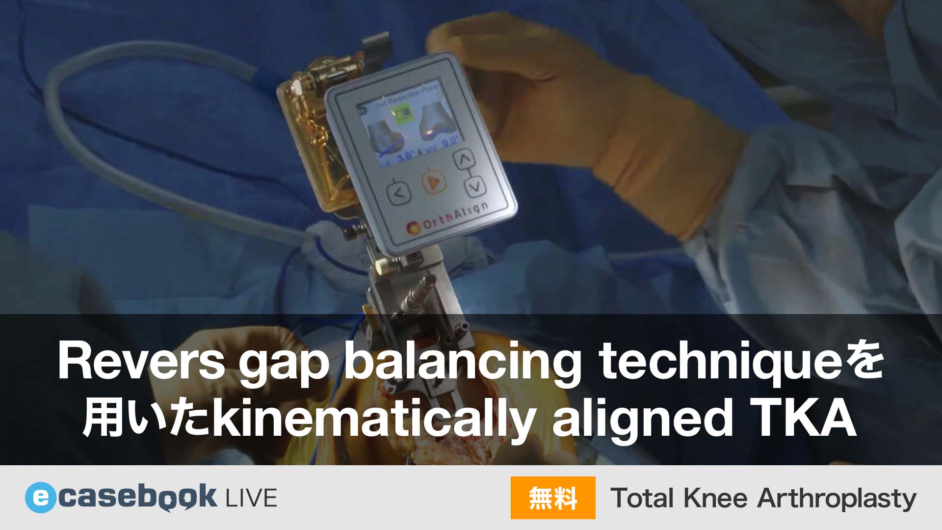 VIDEO: Revers gap balancing techniqueを用いたkinematically aligned TKA [TKA ...