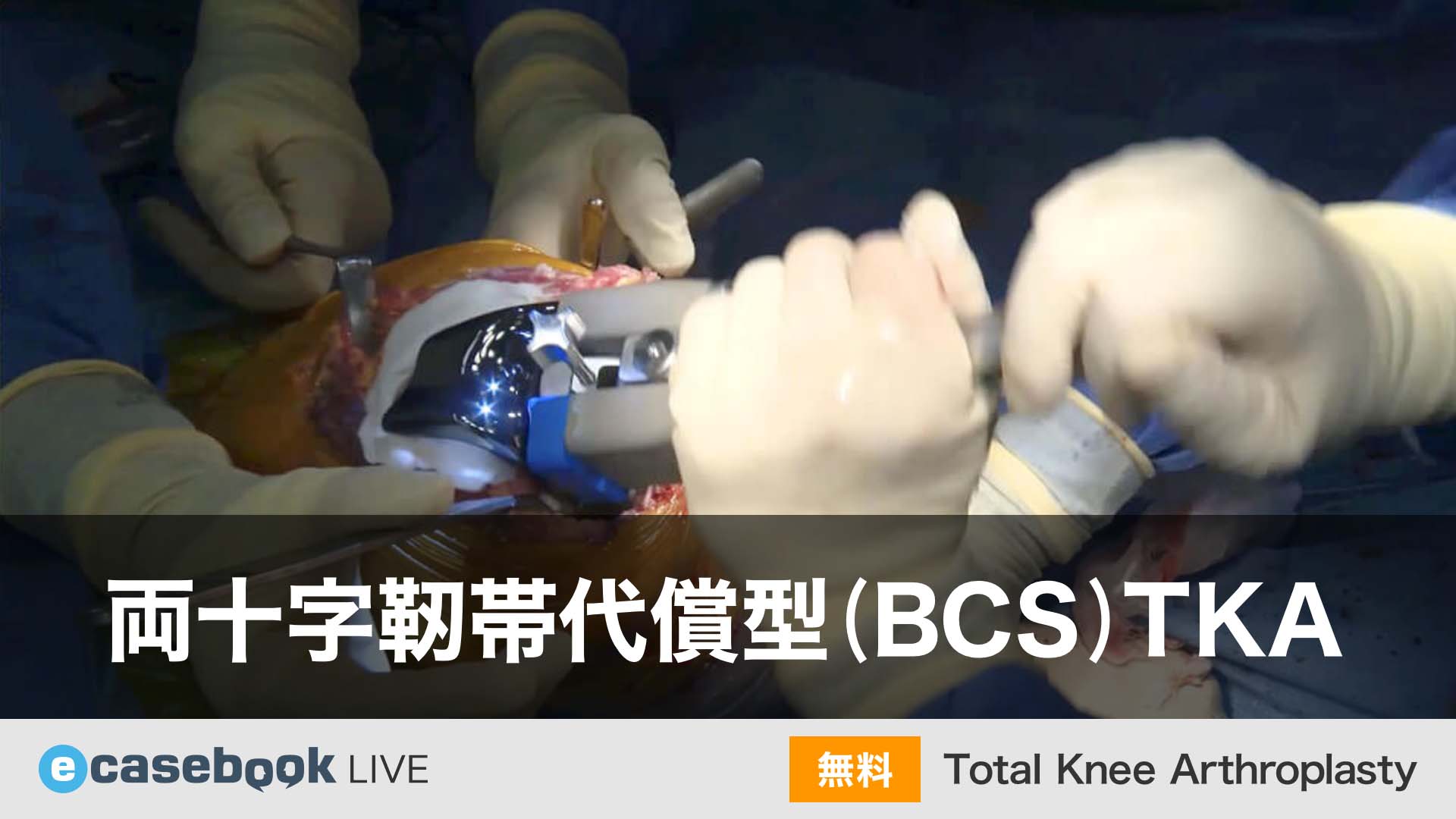 VIDEO: 両十字靭帯代償型 (BCS) TKA [TKA] | Orthopedics | e-casebook LIVE