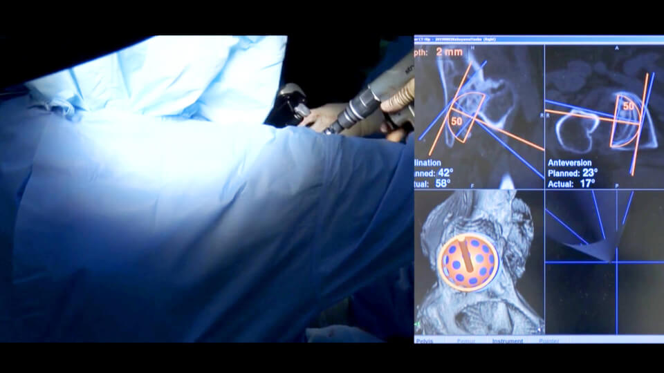 VIDEO: CTベースナビゲーションを用いた後方進入THA [THA] | Orthopedics | e-casebook LIVE