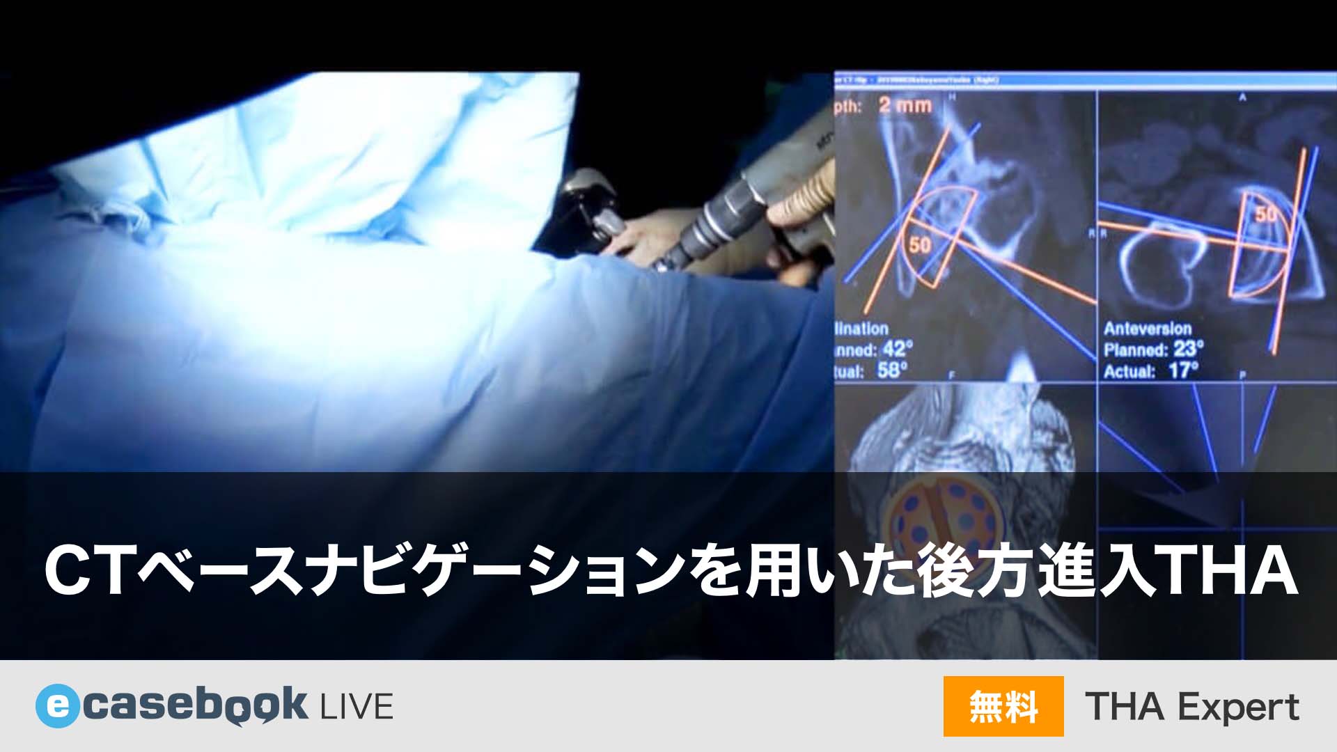 VIDEO: CTベースナビゲーションを用いた後方進入THA [THA] | Orthopedics | e-casebook LIVE