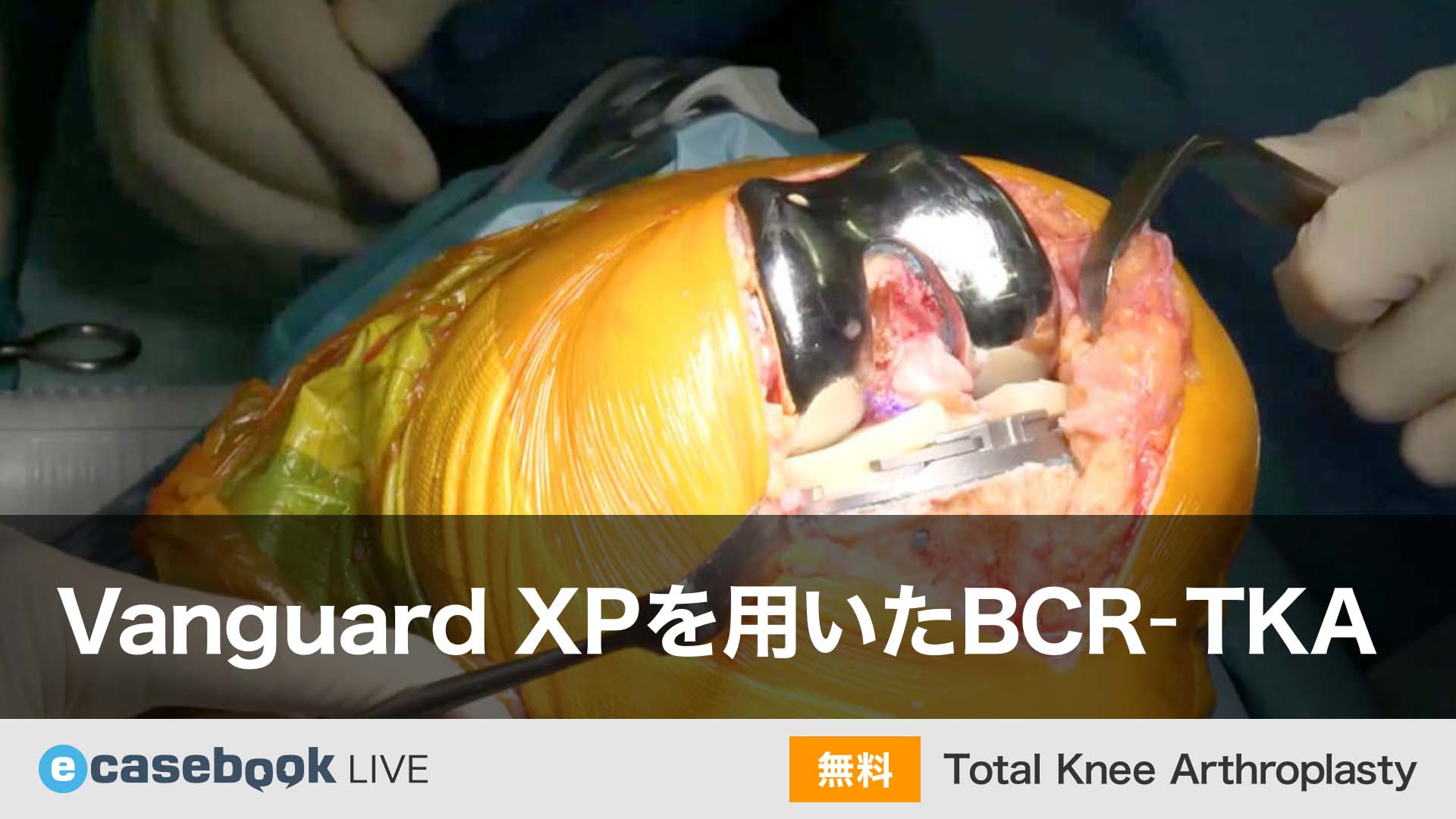VIDEO: Vanguard XPを用いたBCR-TKA [TKA] | Orthopedics | e-casebook LIVE
